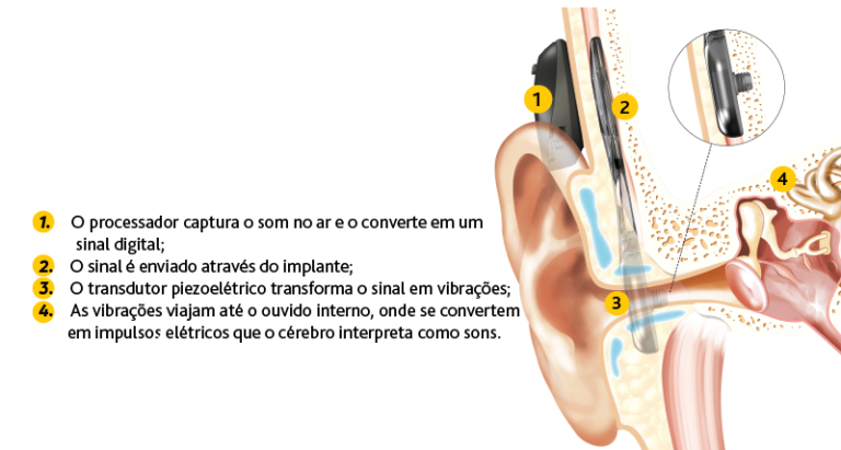 Osia®, um novo implante de condução óssea da Cochlear